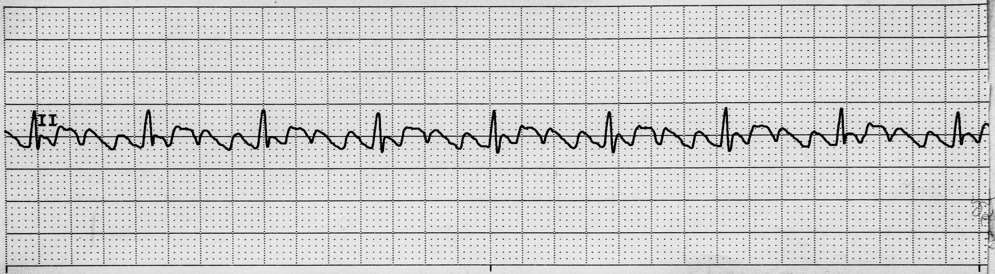 7.4 ECG Patterns and Dysrhythmias – Nursing Advanced Skills